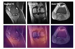 Automate the diagnosis of Knee Injuries 🏥 with Deep Learning part 1: an ...